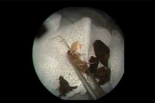Hear Him Out Giant Bug Found Hiding In Mans Ear Pest Management Professional Pest Management